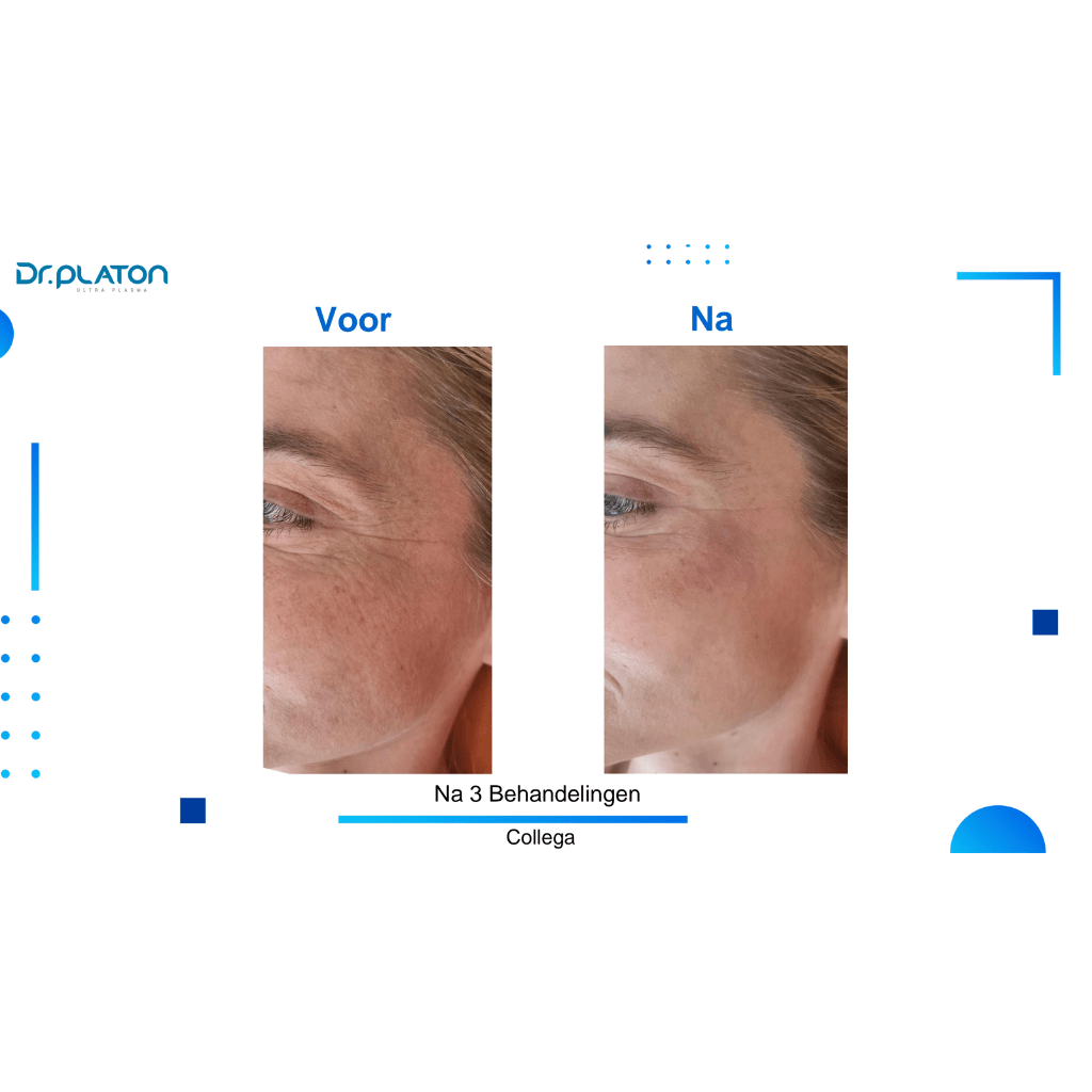 DR Platon Cold Plasma